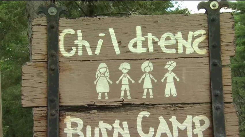 Camp in Union Provides Refuge for Children Who Suffer from Severe Burns ...
