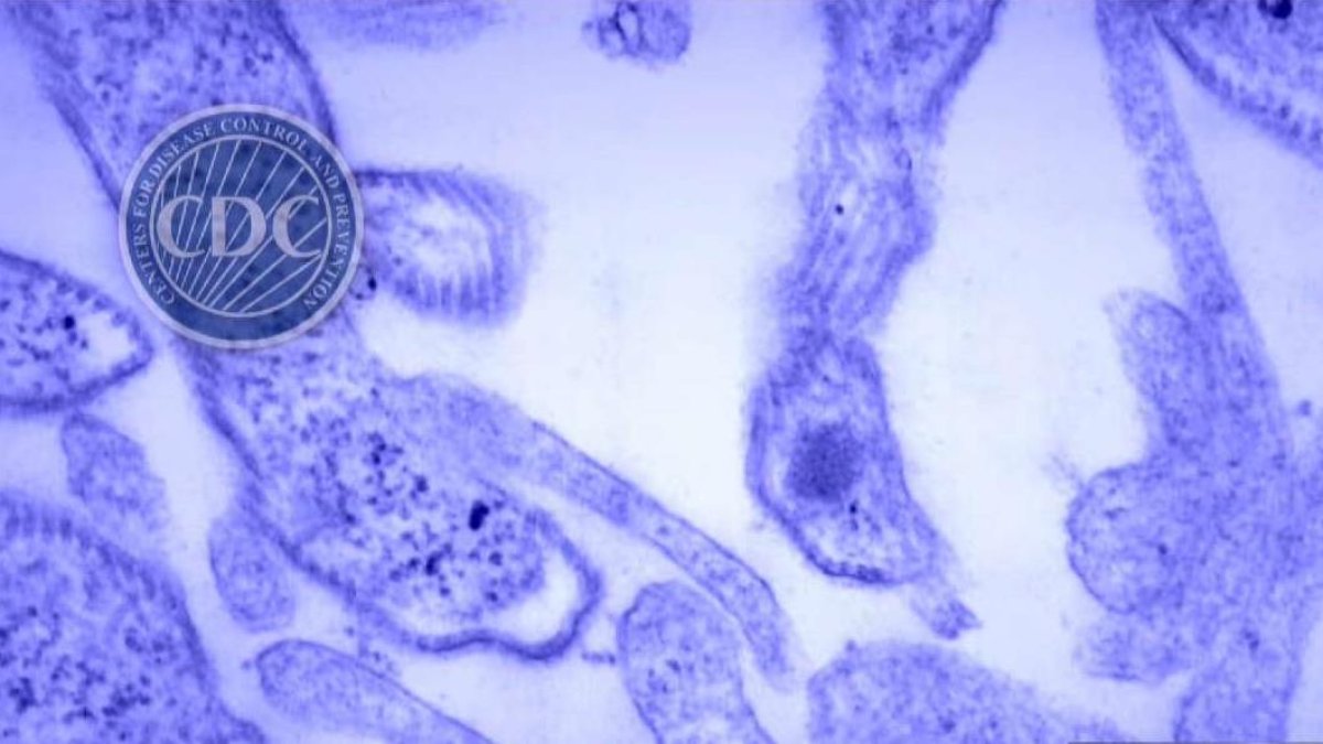 Mumps Cases Reported in Connecticut – NBC Connecticut