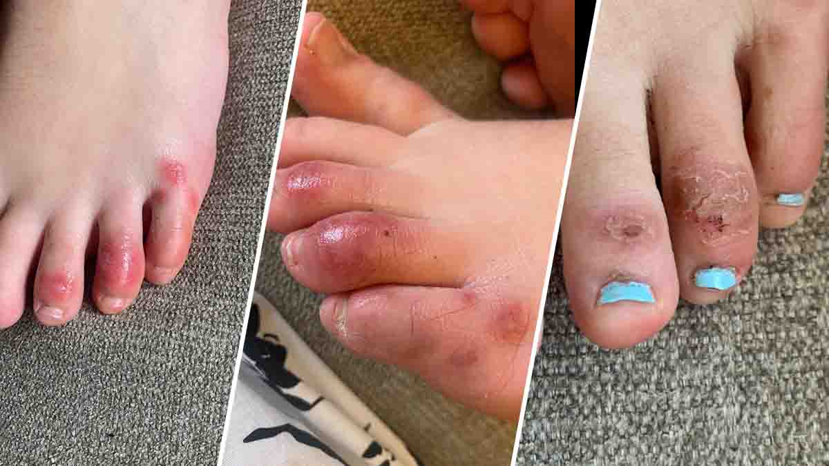 ‘COVID Toes’: Mysterious Skin Condition Could be Linked to Coronavirus ...