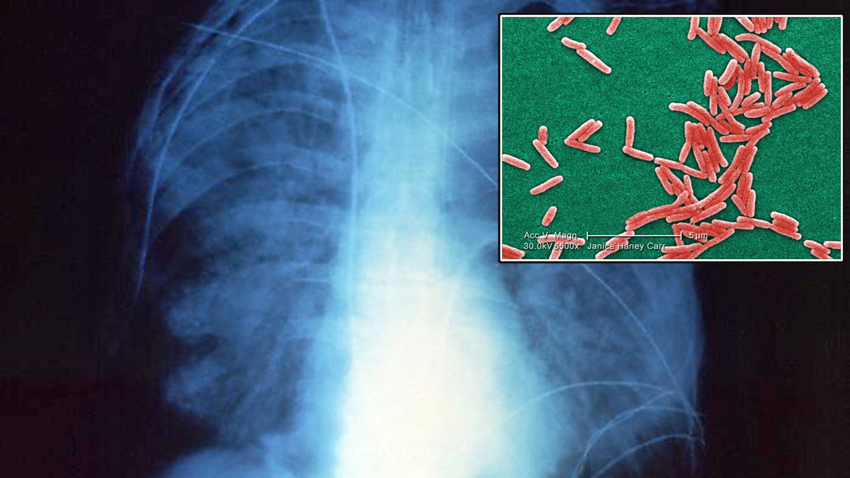 What is Legionnaires’ disease? – NBC Connecticut