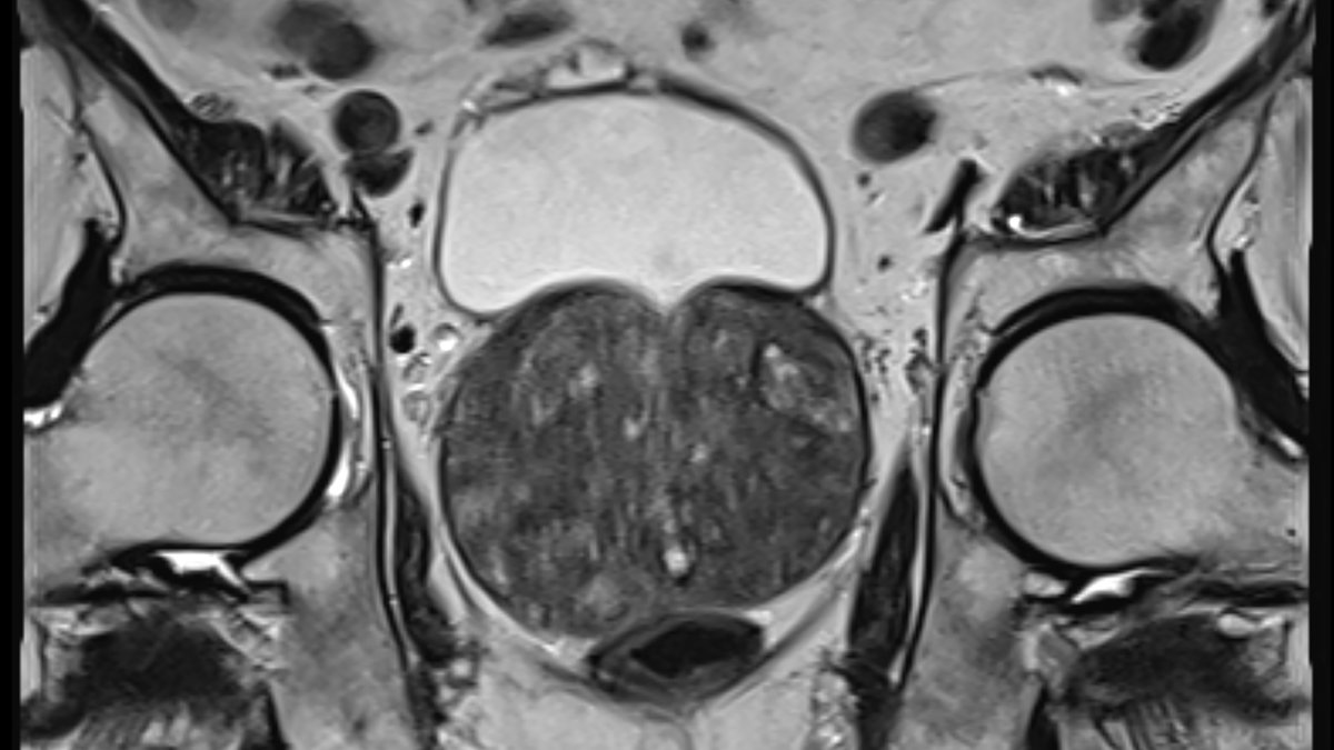 What are the symptoms of an enlarged prostate and how is it treated ...
