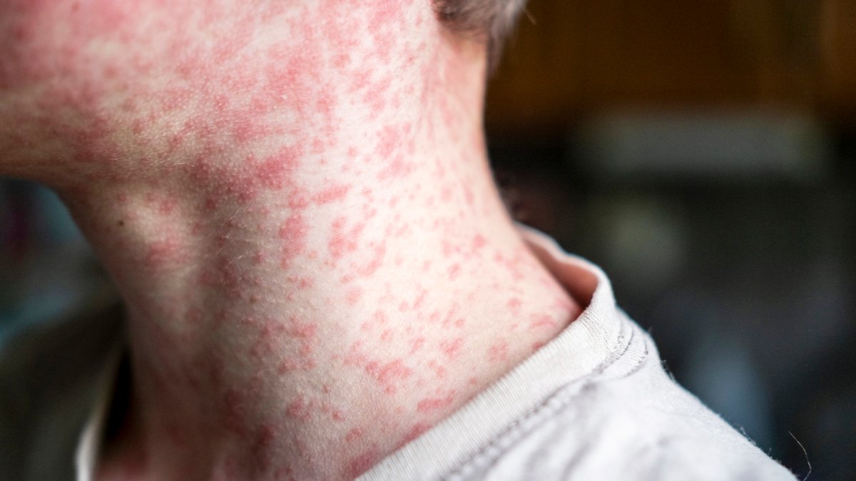 Measles cases in the U.S. are already triple last year’s total, and it ...