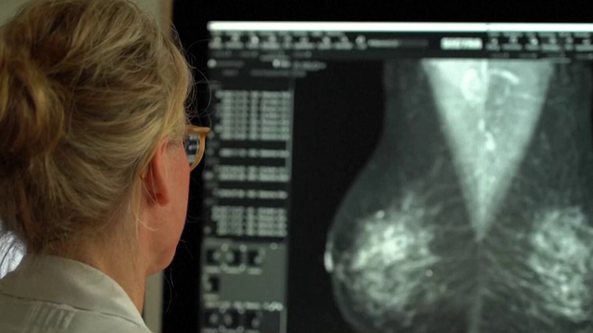How CT paved the way for a national dense breast tissue policy – NBC ...
