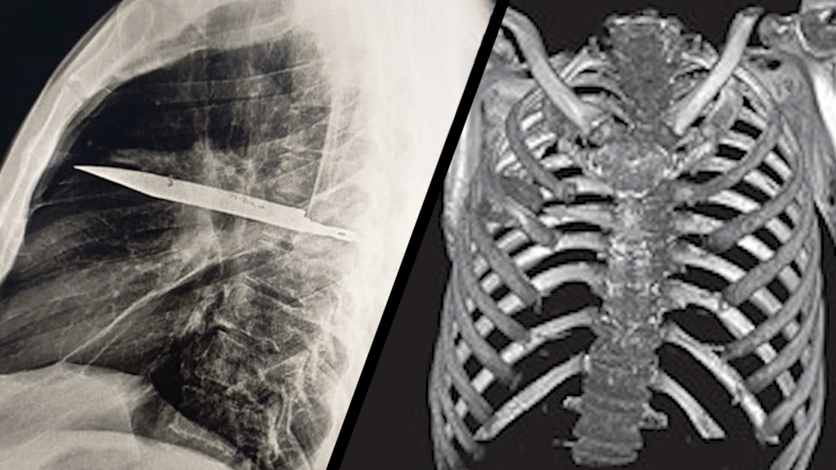 Doctors find knife in man’s chest 8 years after he was stabbed – NBC ...