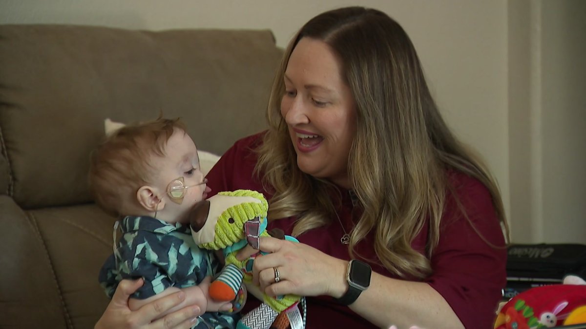 Major surgery nears for baby with facial defect – NBC Connecticut